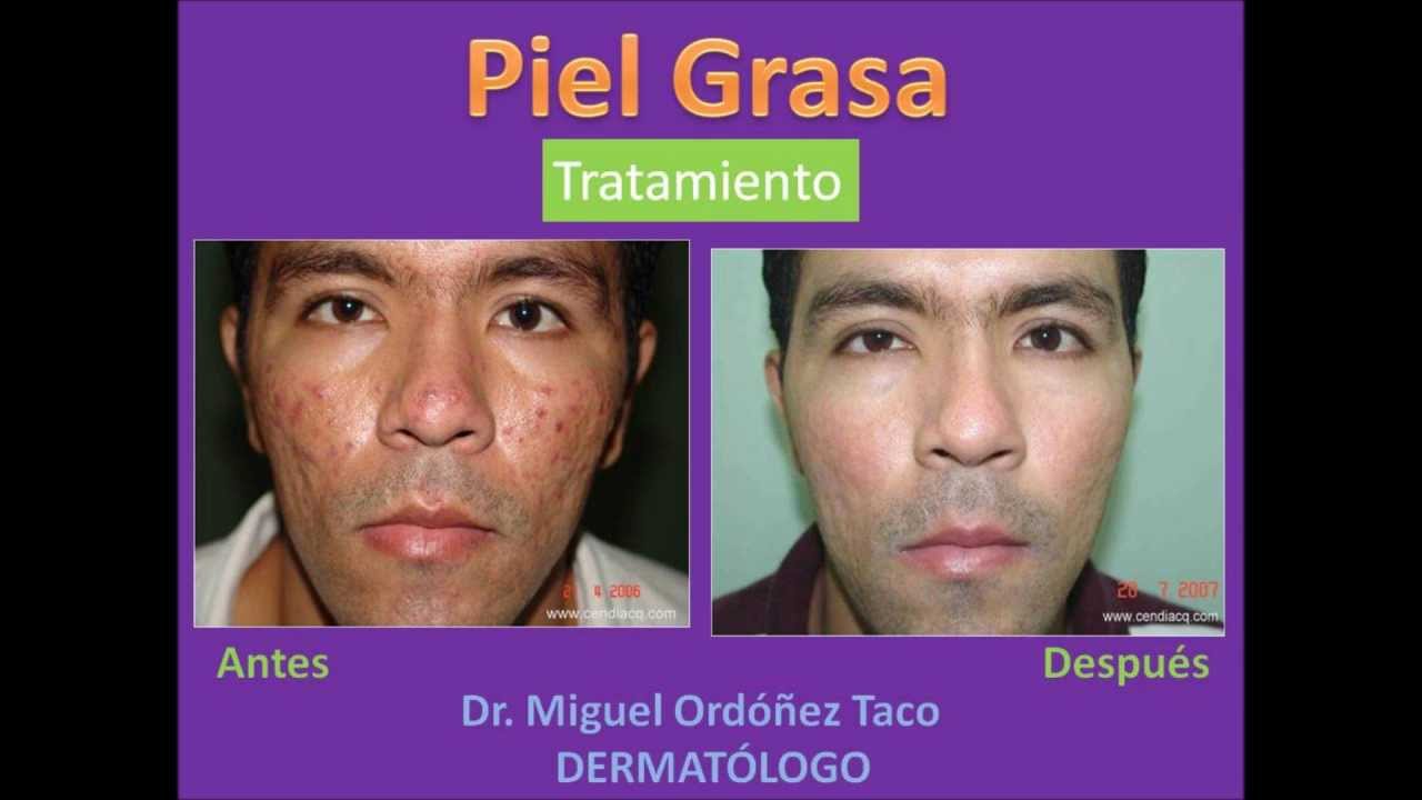 ¿QUÉS LA PIEL GRASA O CUTIS GRASO? (Dermatólogo en Guayaquil) - YouTube