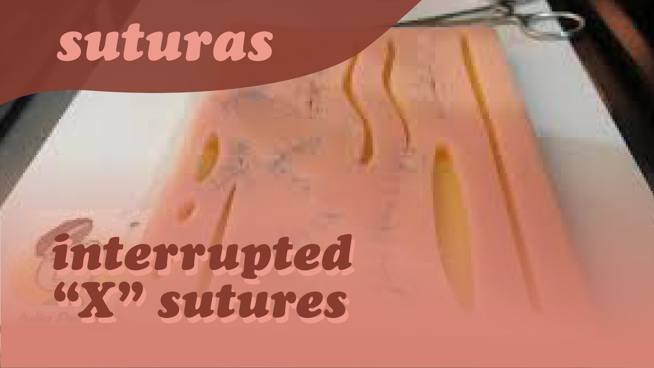 Interrupted 'X' Sutures - YouTube