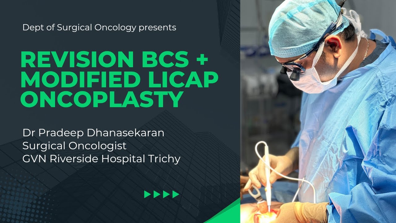 BCS with LICAP Flap Oncoplasty | Dr Pradeep | Surgical Oncologist ...