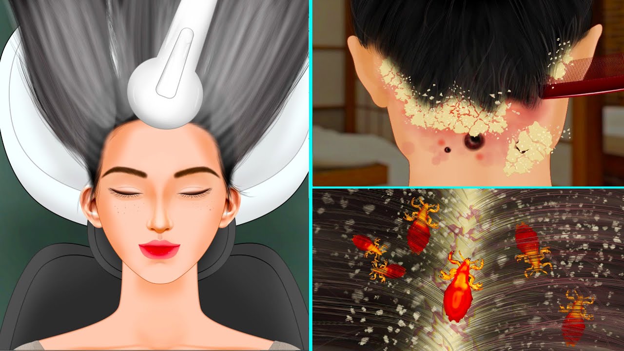 ASMR Get rid of tons of head lice and Dandruff of dirty girl - 근질근질 머릿니 ...