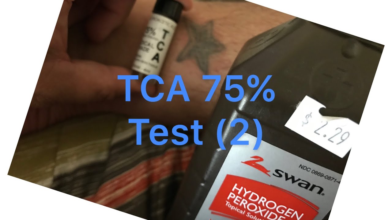 Average Mike Show #47 Home tattoo removal #4 TCA + Peroxide - YouTube