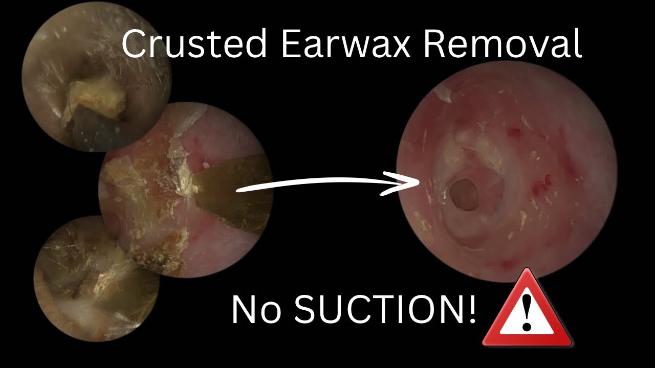 Crusted EarWax removal | Satisfying - YouTube