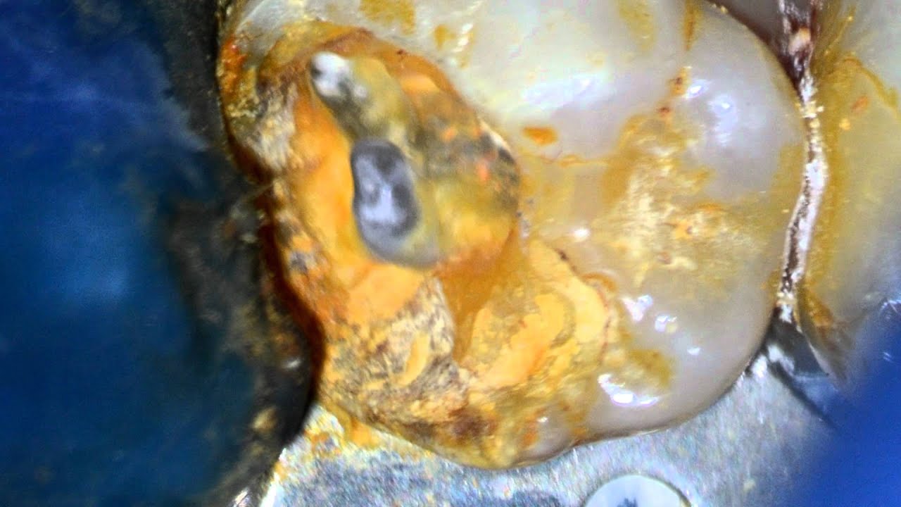 Finding MB2 in Maxillary Molar Root Canal Treatment - YouTube