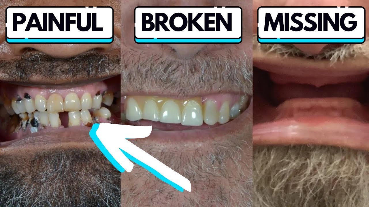 3 Men, 24 Hrs: Life-Changing Teeth Transformations - YouTube