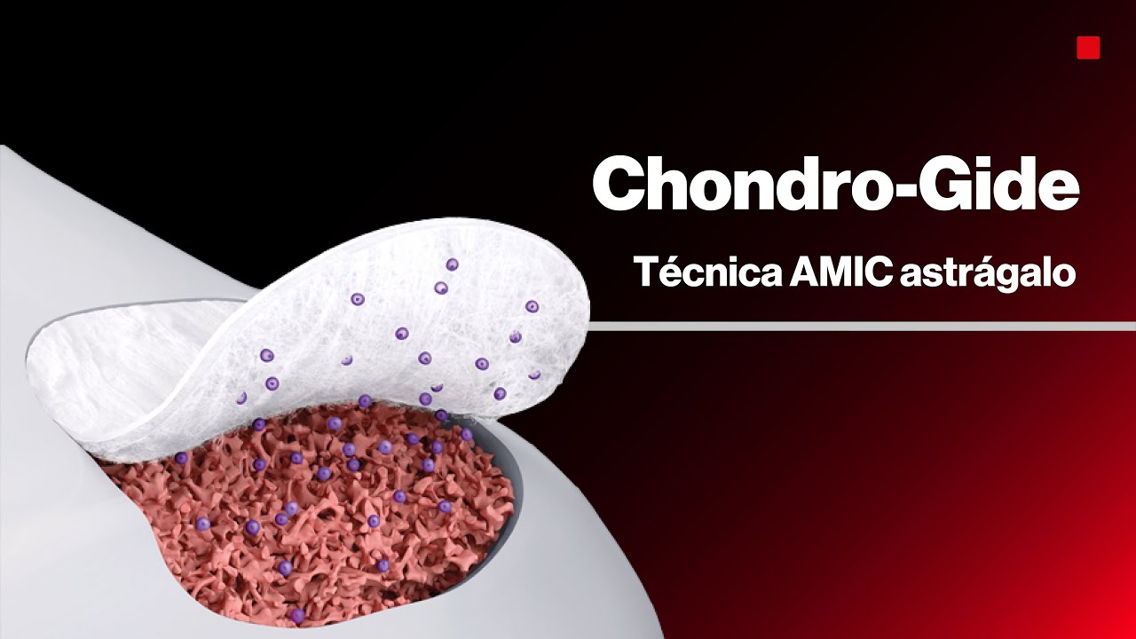 AMIC CHONDRO-GIDE® | Reparación de cartílago en el astrágalo - YouTube
