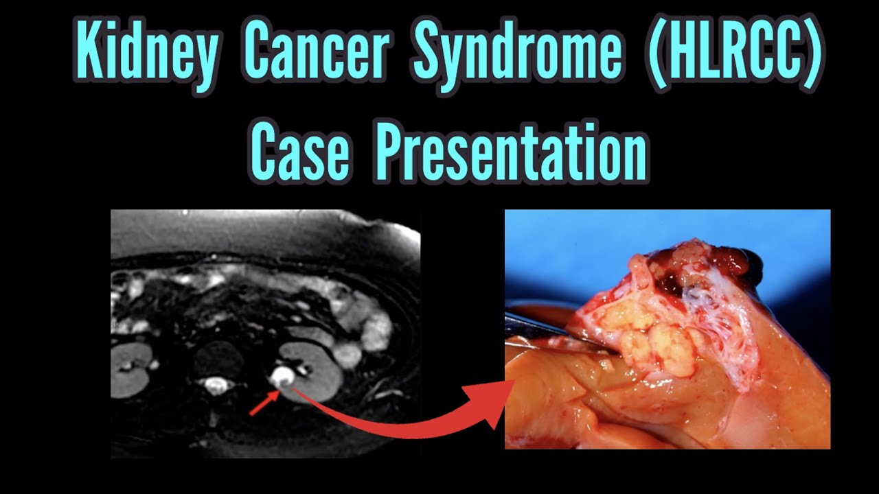 Kidney Cancer Syndrome Case Presentation: Radiology review, Surgical ...