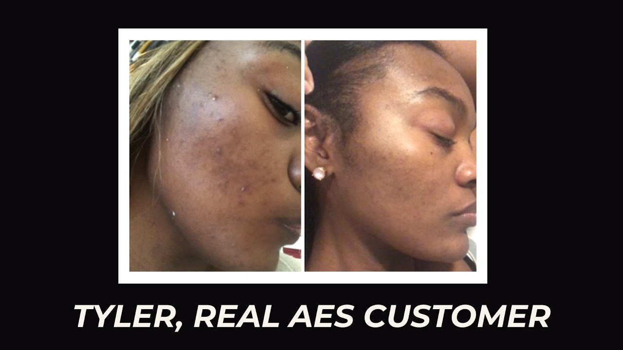 TYLER, REAL AES CUSTOMER - YouTube
