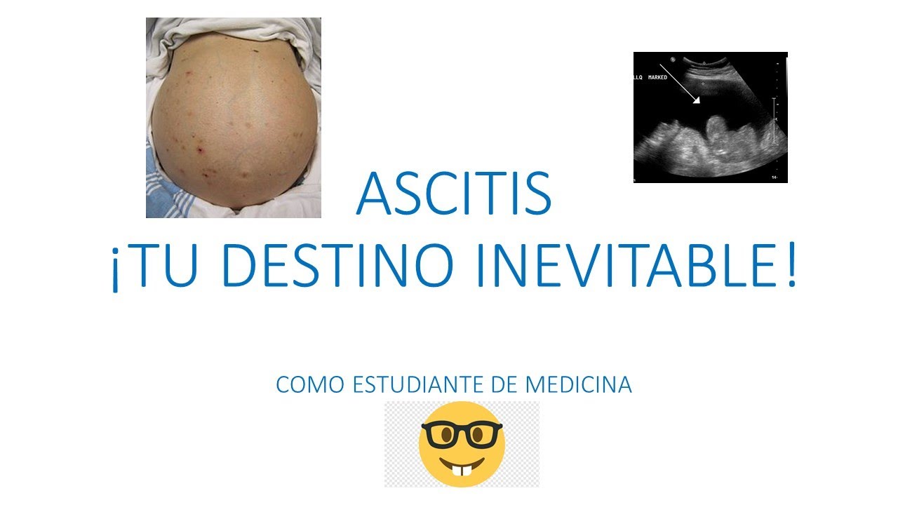 Ascitis para estudiantes de Medicina - YouTube