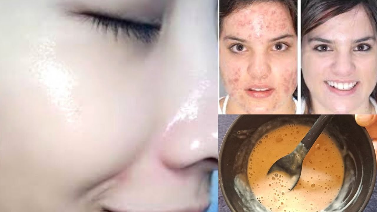 How to cure acne fast and effectively ...