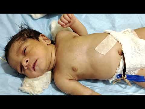 New born so big healthy baby weight 3.6 kg baby passed meconium during ...