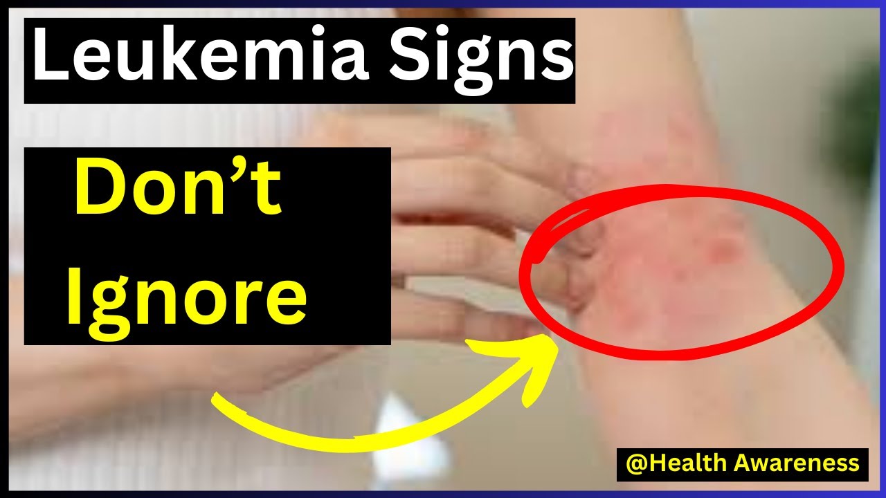 8 Early Warning Signs And Symptoms of Leukemia You Should Know. # ...