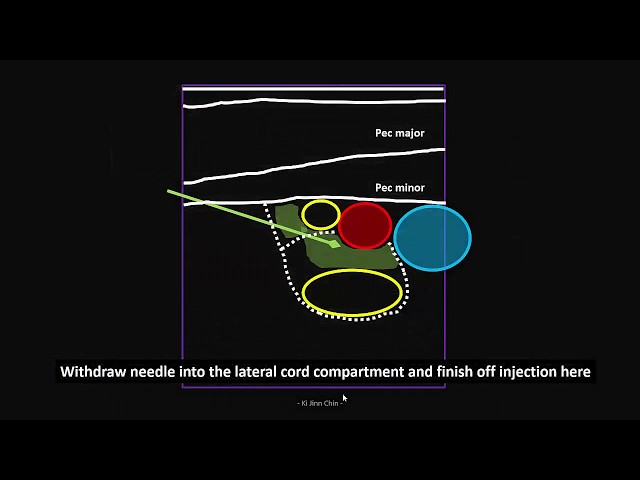 Infraclavicular Nerve Block Ultrasound Guided Nerve Block Overview