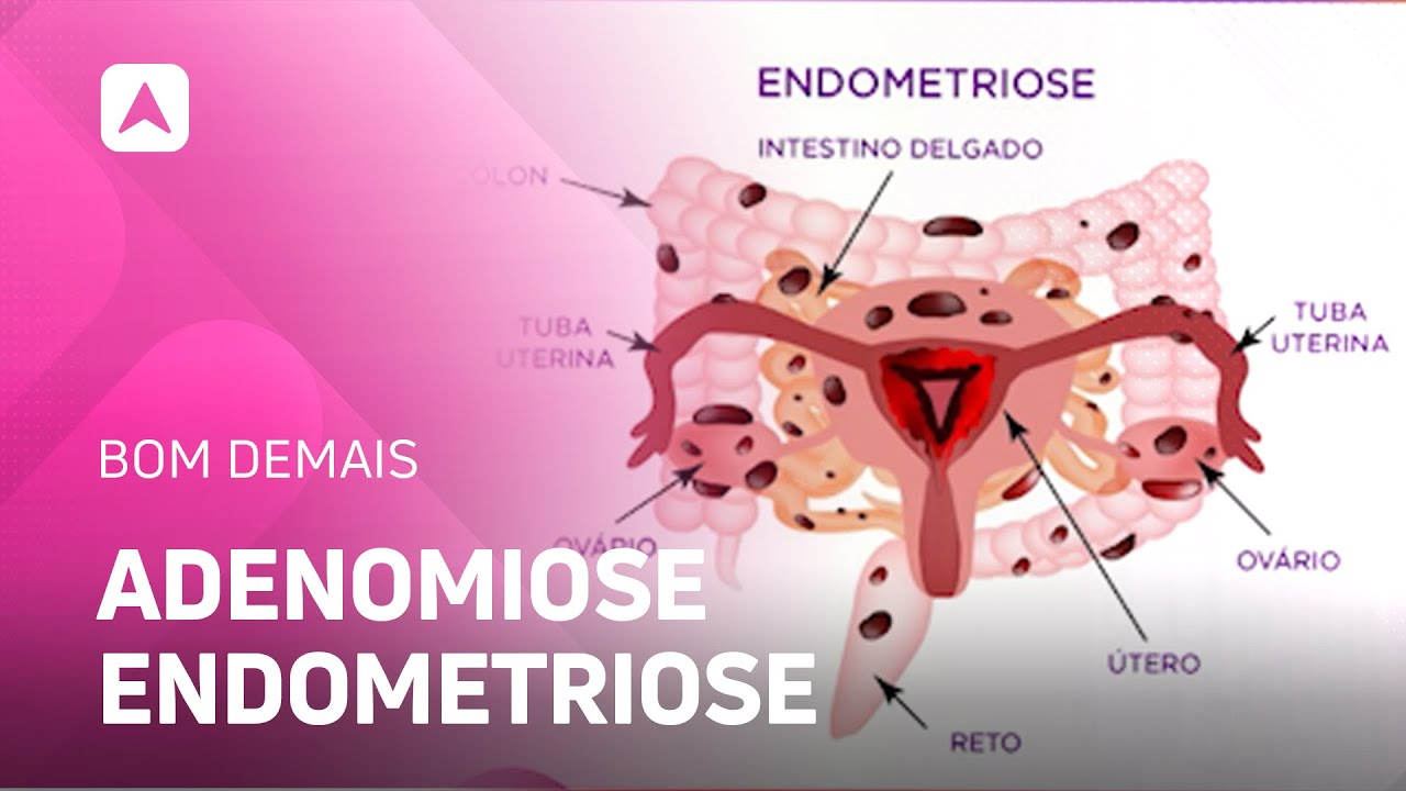 Adenomiose x Endometriose: especialistas explicam a diferença - YouTube