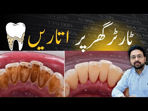 Instant Teeth Cleaning 🦷 TARTAR Removal Secret Trick I Smile Reset Remedy