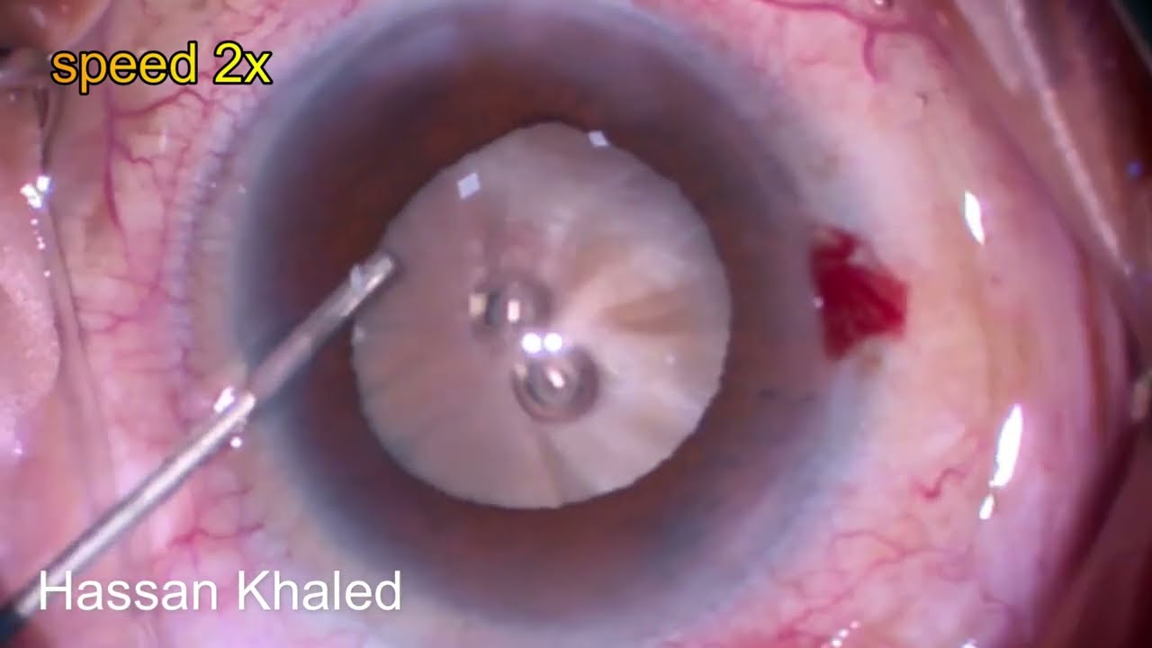 CAPSULaser SLC &Dense Brown Cataract (Horizontal Chop) - YouTube