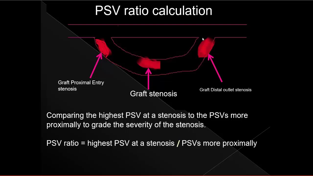 11 peripheral arterial triplex ultrasound bypass graft surveillance ...