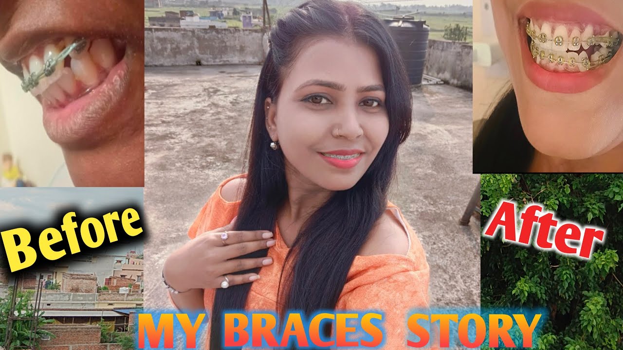 Braces Journey Before And After|| Braces Journey Before And After Vlog ...