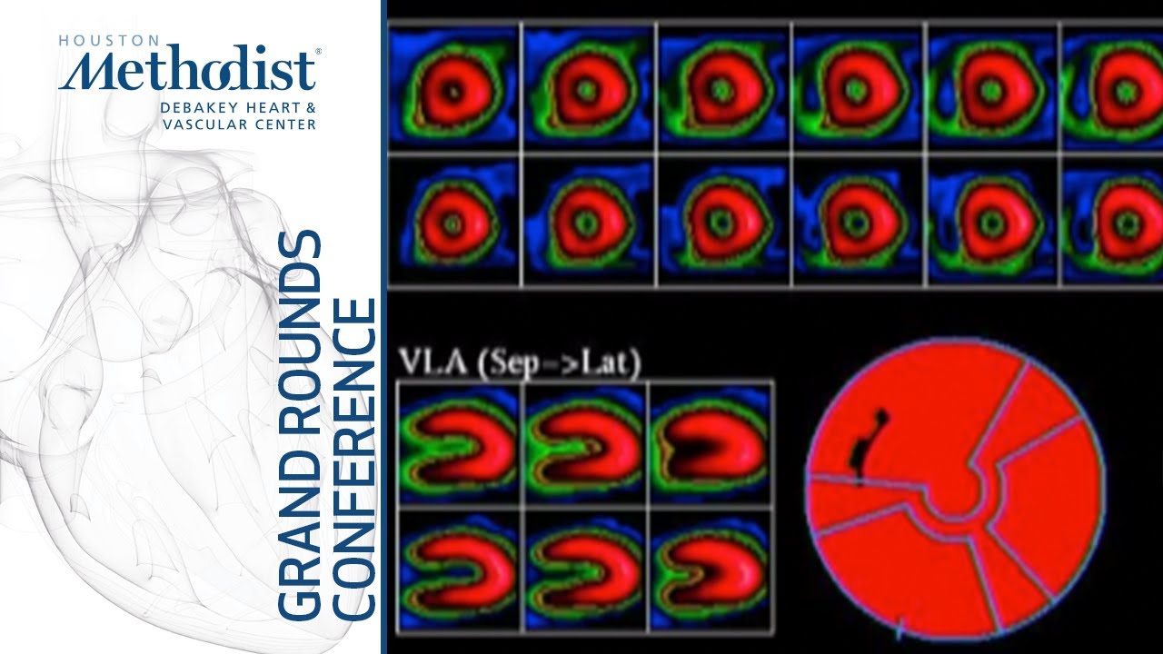 Predicting Risk & Guiding Therapeutic Decision-making in Stable CAD ...