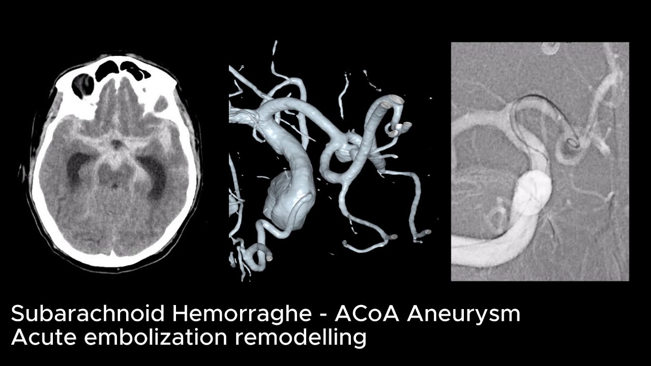 ACoA Aneurysm - Remodelling embolization - YouTube