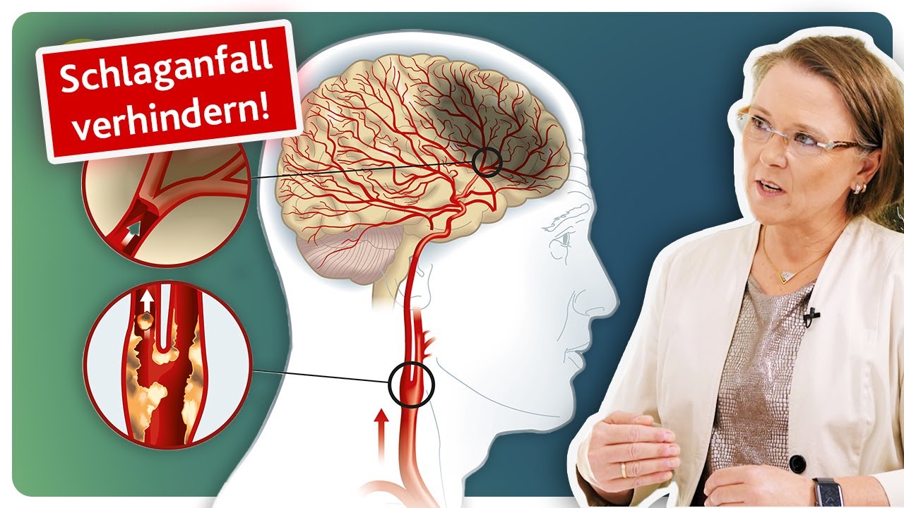 Verengung der Halsschlagader rechtzeitig erkennen | Diagnose ...