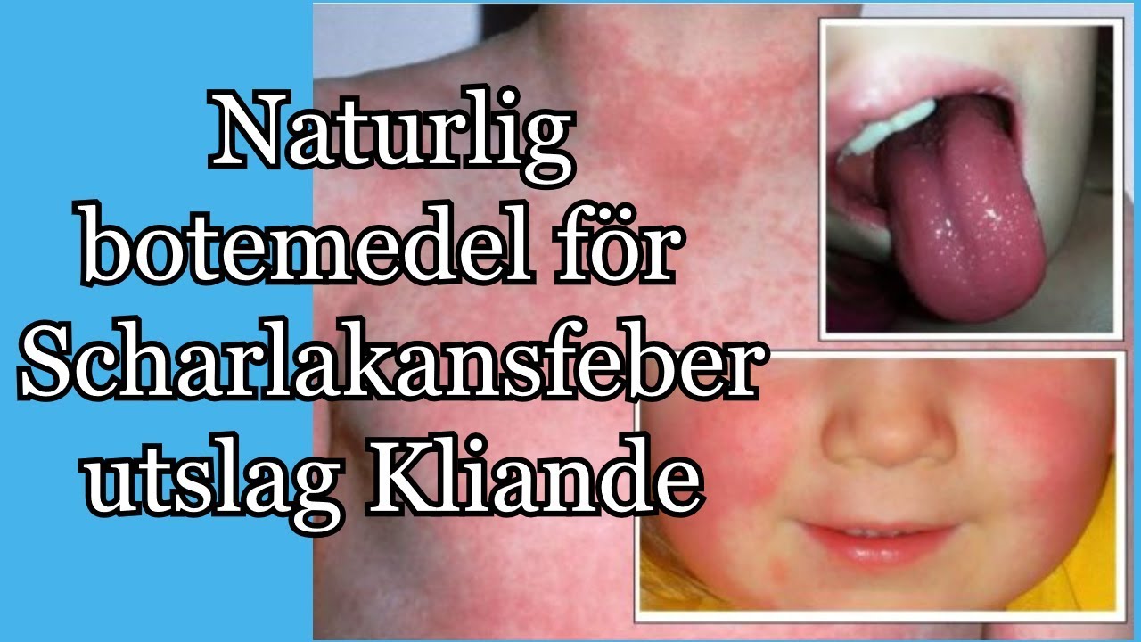 Naturlig botemedel för Scharlakansfeber utslag Kliande - YouTube