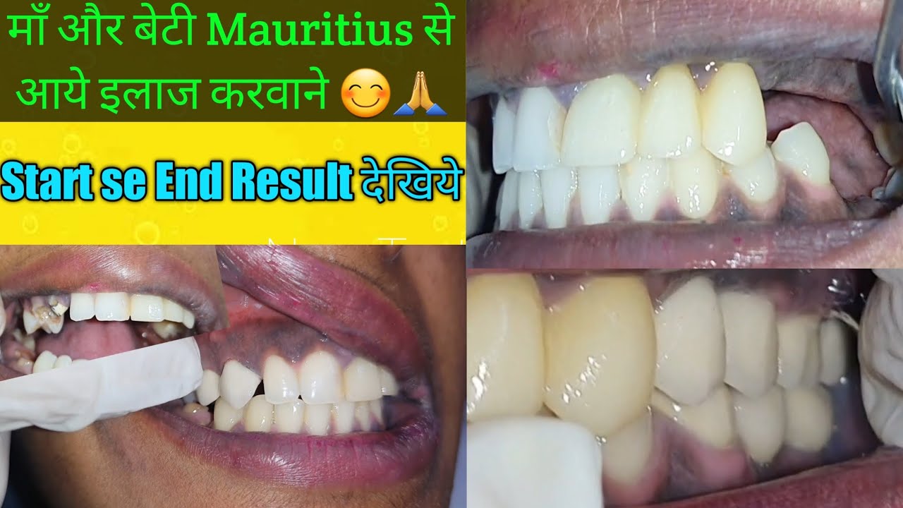 Get Dental Implant and fix teeth in 5 days - YouTube