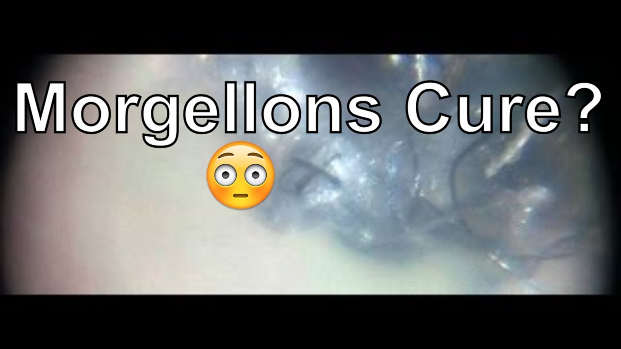 How to Cure Morgellons - YouTube
