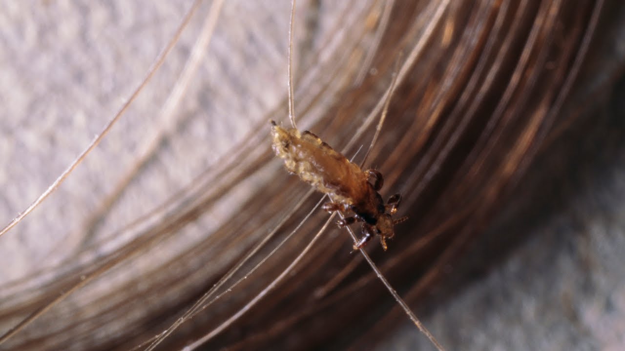 What Happens If Lice Goes in Your Ear - YouTube