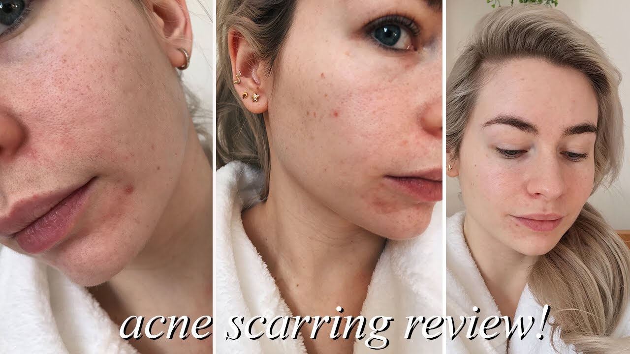 TRYING A CREAM FOR MY ACNE SCARRING | ad - YouTube