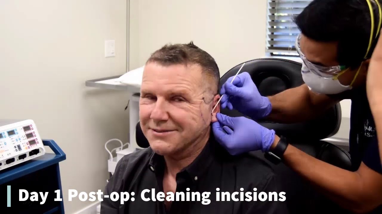 Eric's Face Lift Experience With Facial Plastic Surgeon Dr. Sudeep Roy ...