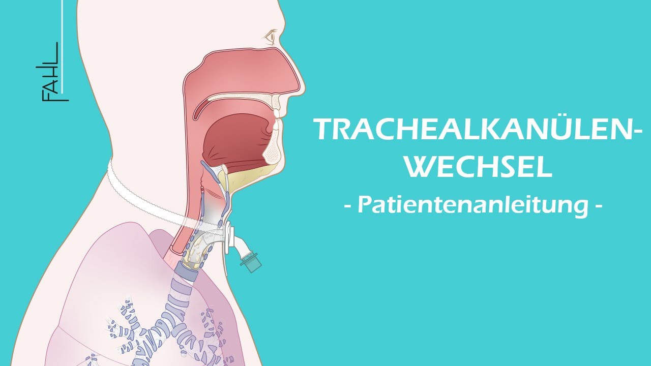 Trachealkanülenwechsel für Patienten | Animation | Fahl Medizintechnik ...
