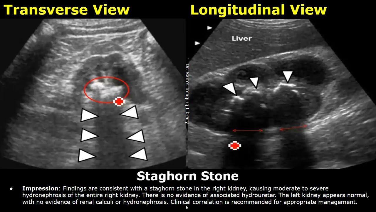 Left Kidney Ultrasound