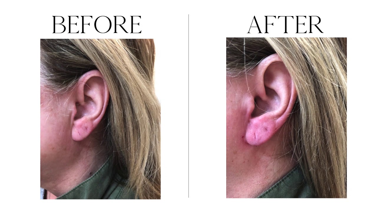 Dermal Fillers: Earlobe Filler - YouTube