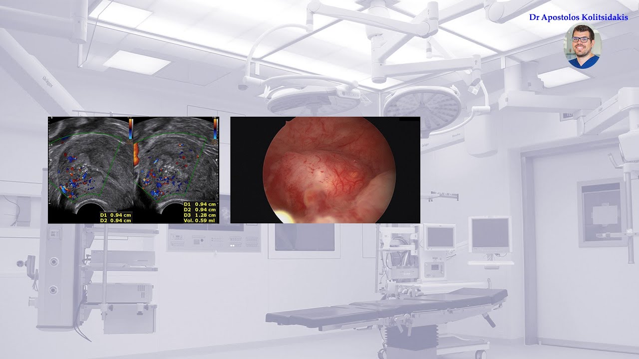 Hysteroscopic Resection of a FIGO Type II Myoma - YouTube