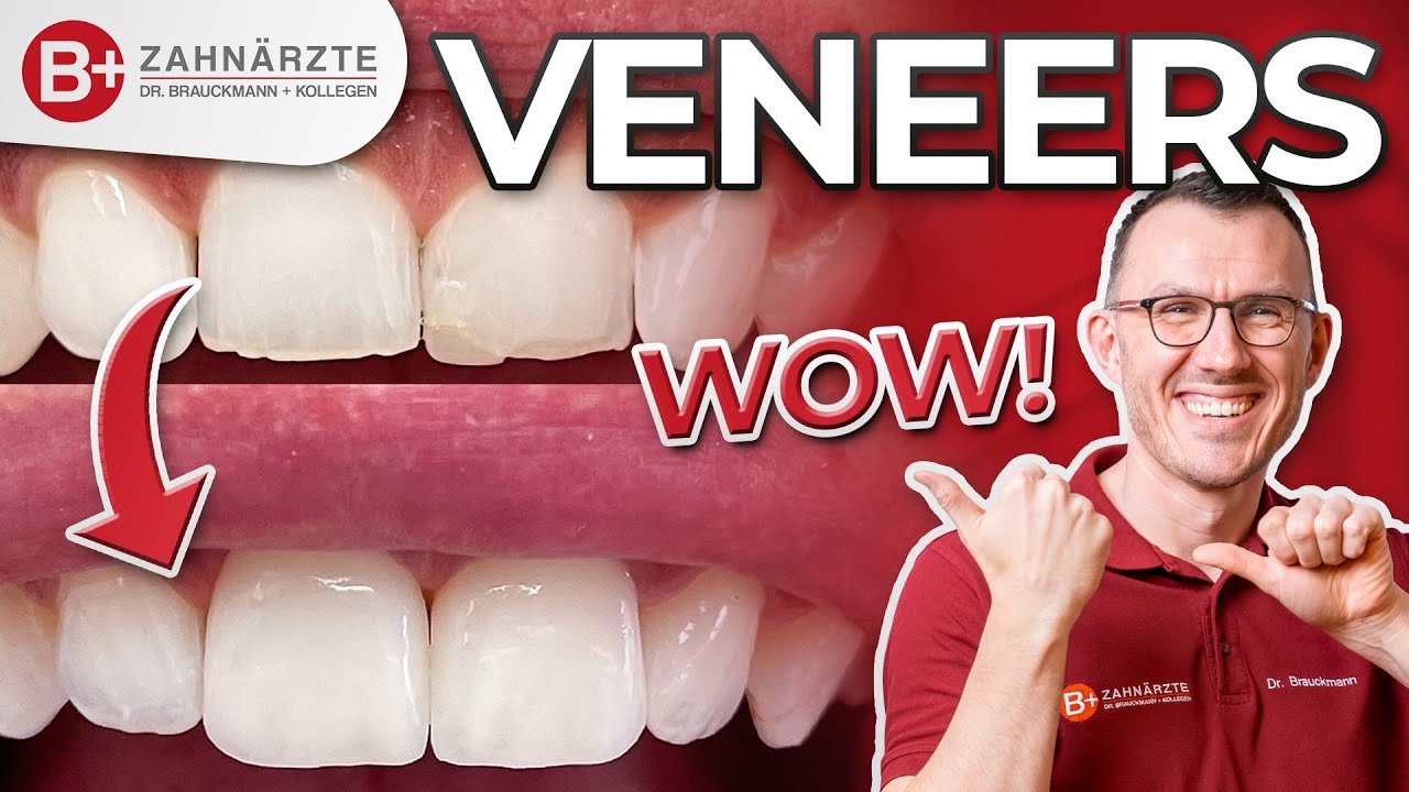 Frontzahn Veneers! Behandlung und Vorher-Nachher Vergleich: Alles ...