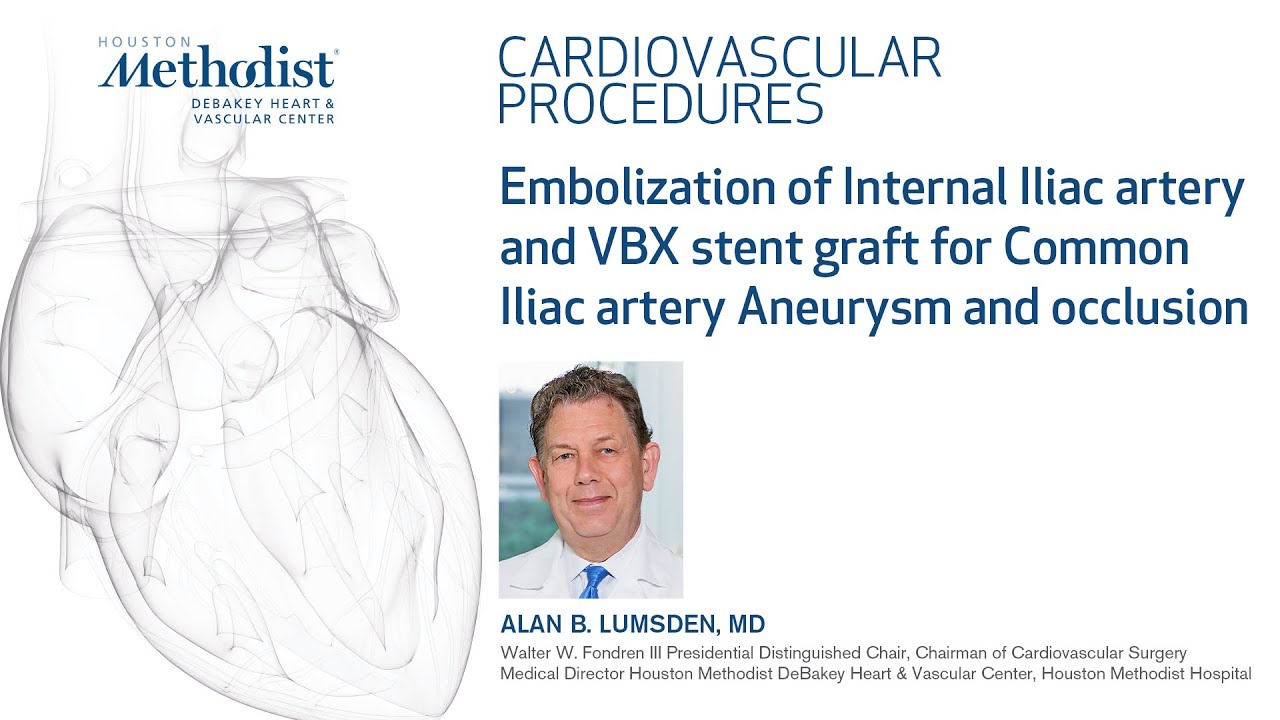 Embolization Of Internal Iliac Artery VBX Stent Graft For Common