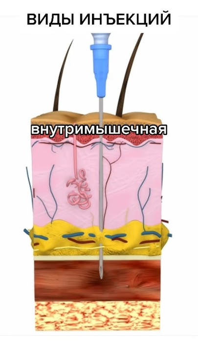 Виды инъекций(уколов) - YouTube