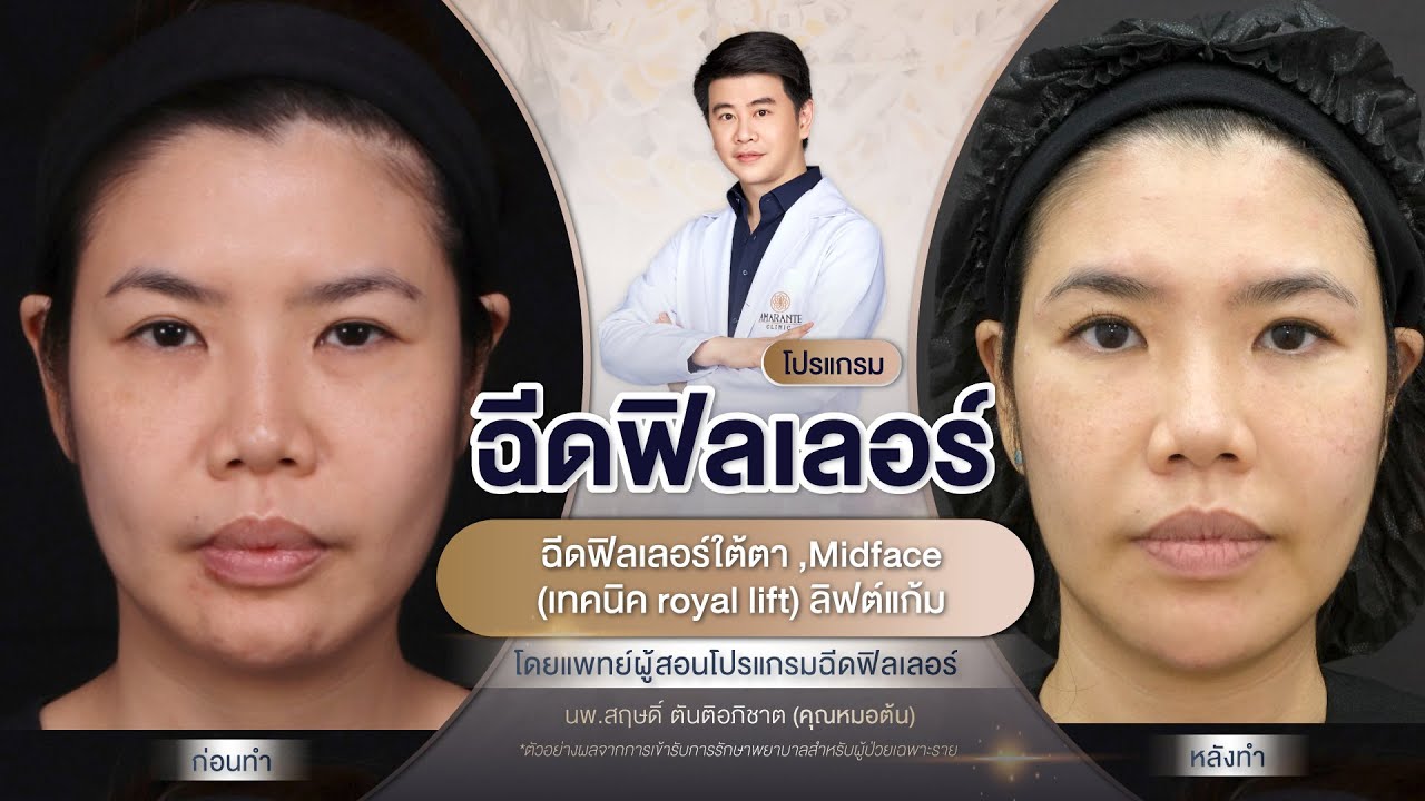 🚩รีวิวฉีดฟิลเลอร์ แก้ไขปัญหาใต้ตาลึกคล้ำ ร่องแก้ม ใบหน้าหย่อนคล้อย ที่ ...