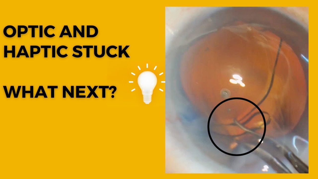 case series 84. Optic and haptic stuck, what next? temporal topical ...
