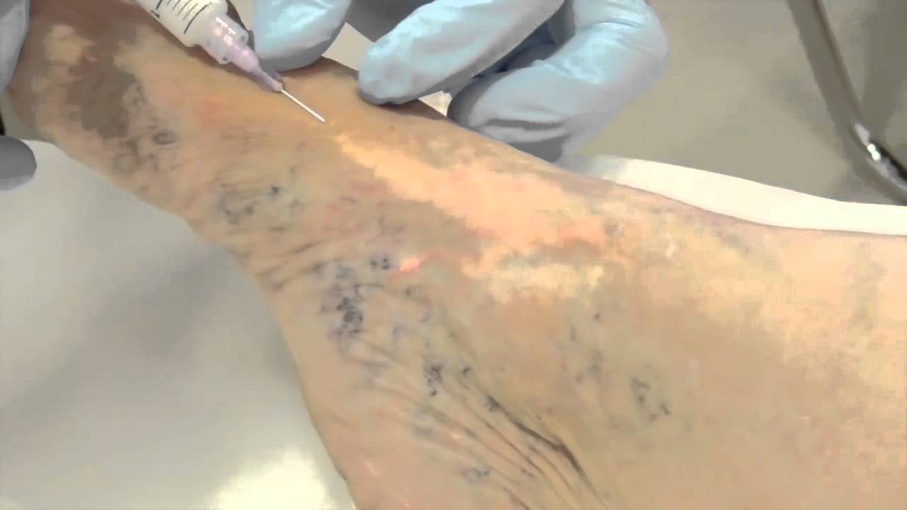 Espuma Densa Polidocanol - YouTube