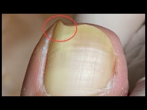 Toenail hard as rock but careful trim it - YouTube