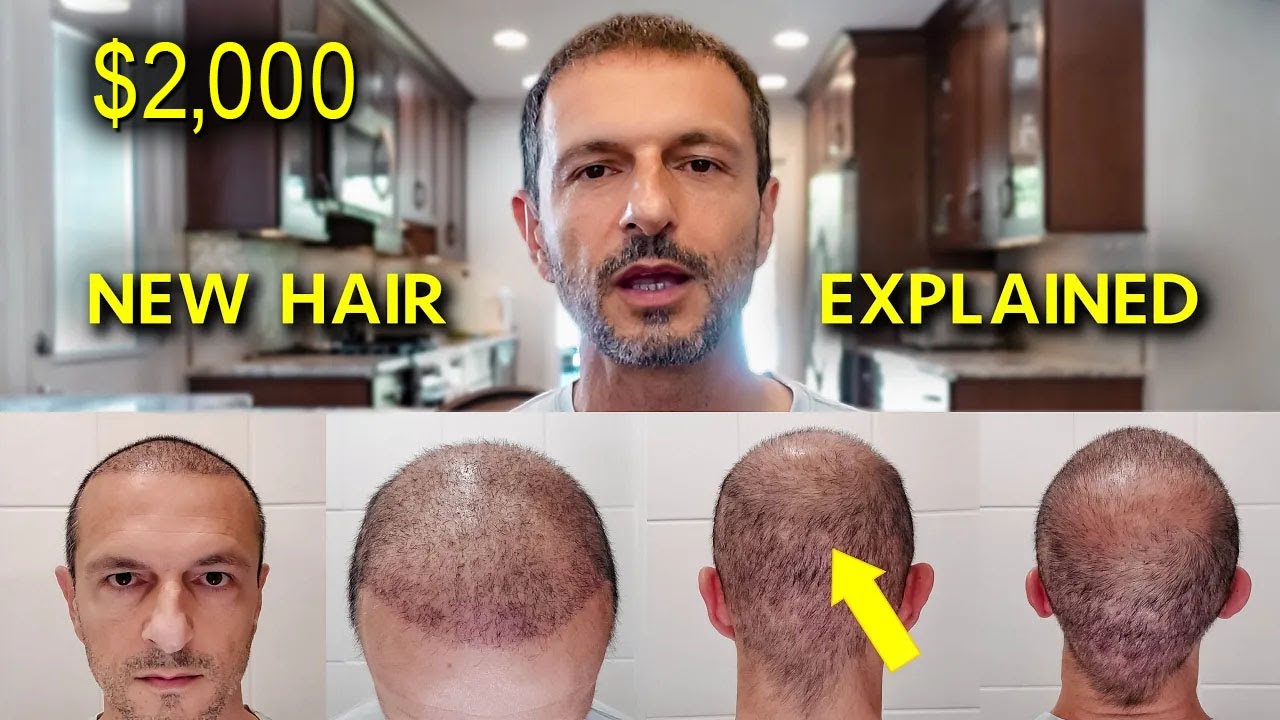 My Turkey Hair Transplant Results After 4.5 Months 🇹🇷 Before and After ...