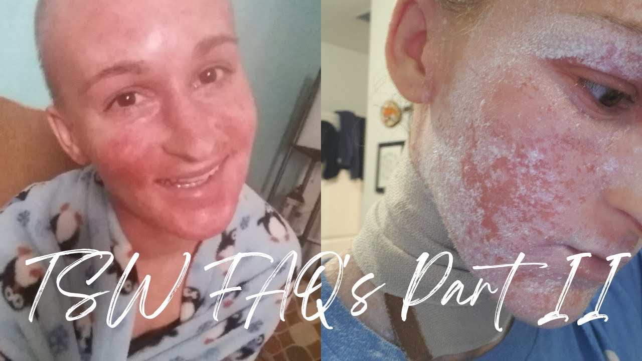 TSW Frequently Asked Questions (Topical Steroid Withdrawal) Part II ...