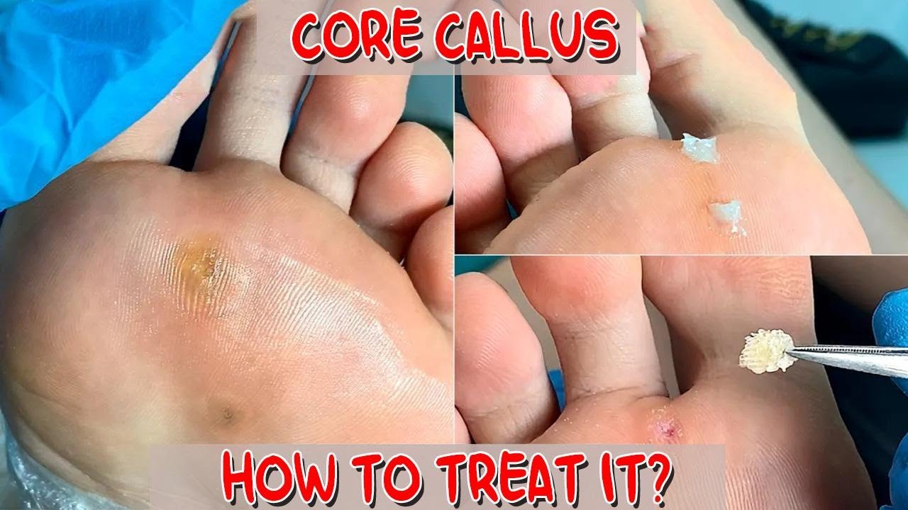 Why Do Calluses Form on Your Feet? Discover the Causes! - YouTube