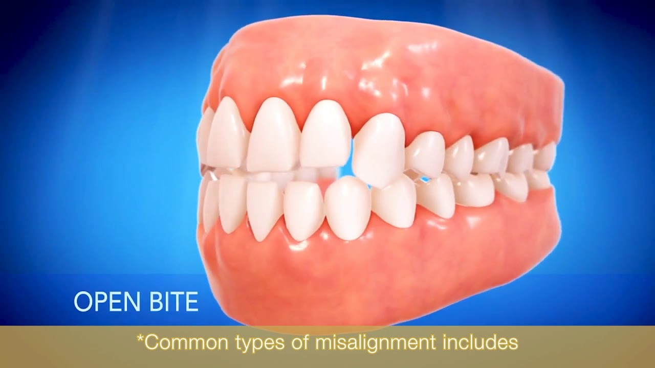 Invisalign Animation Video - YouTube