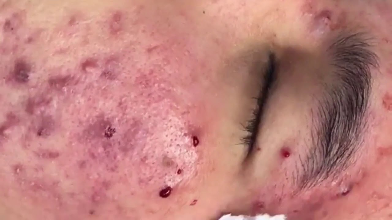 Deep Acne Removal Facial Skin Care Treatment Blackheads Removal ...
