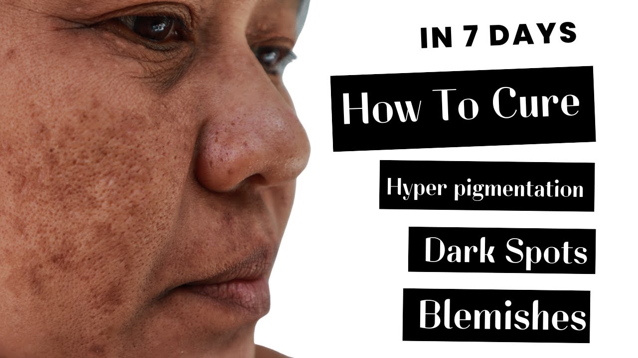 7 Days Challenge _ Hyperpigmentation, Dark Spots And Get Glowing and ...