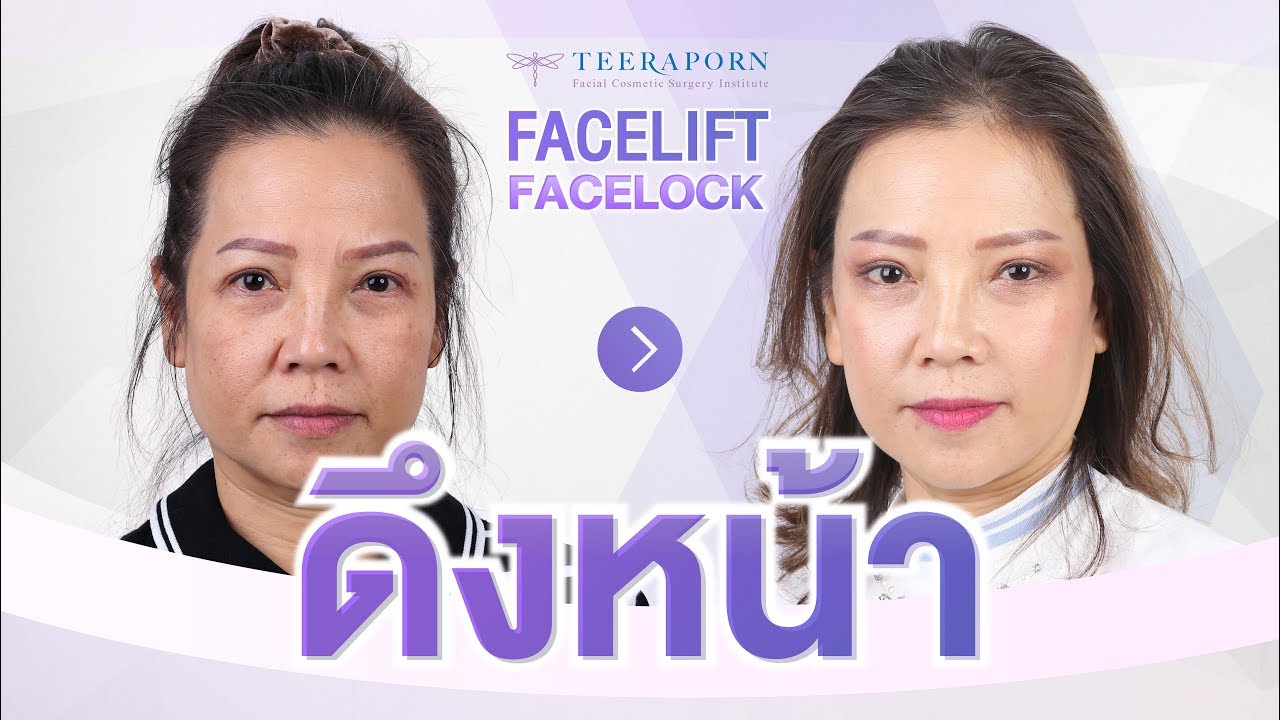 รีวิวดึงหน้า Facelift FACE-LOCK : รีวิวเฟซล็อค 1 เดือน พี่ม้อยสาวลอนดอน ...