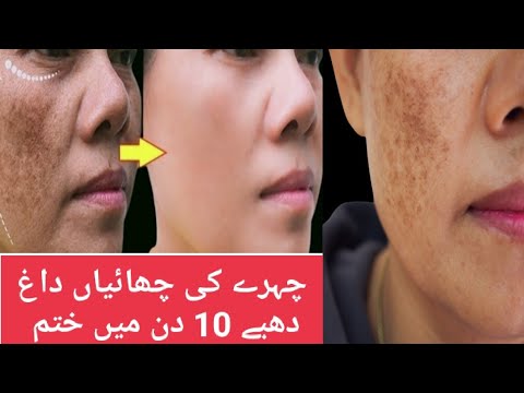 Melazam Cream Best cream for melasma treatment ll chahre ki chaiyon or ...