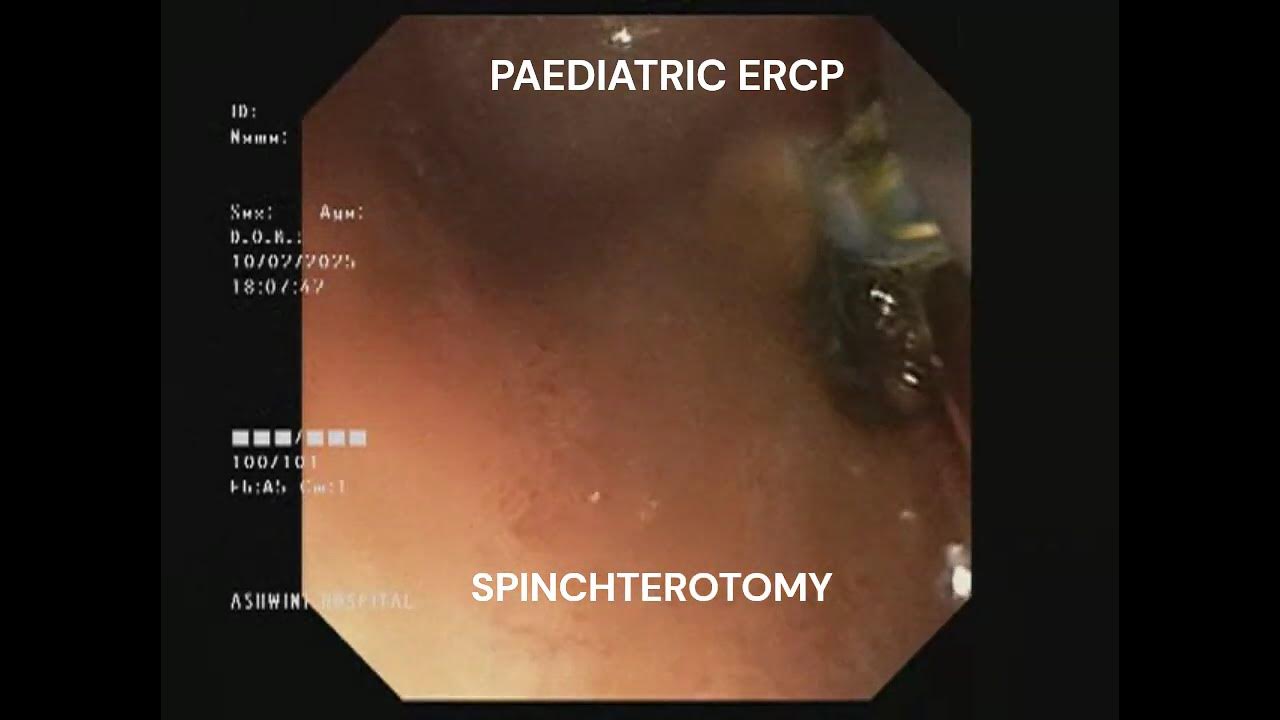 Endoscopic Removal of Bile Duct Stones in Children | Pediatric ERCP Procedure Explained #ERCP ...